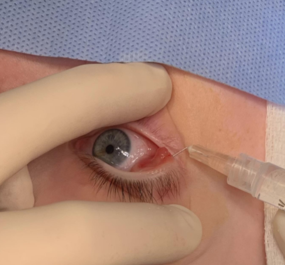 Removal of chalazion store